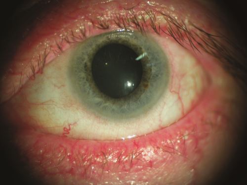 Staphylococcal Blepharitis