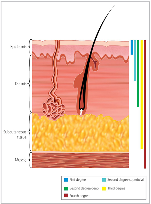 4th Degree Burn Diagram
