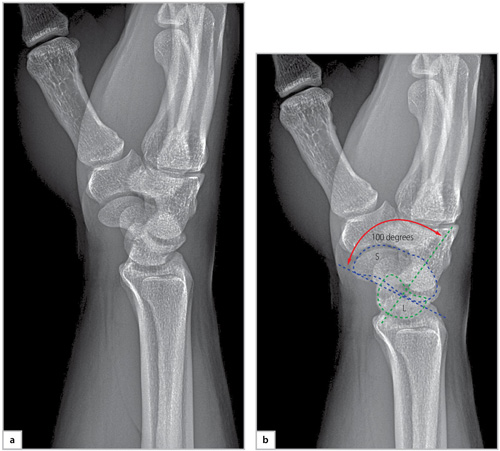 Scaphoid X Ray Angle