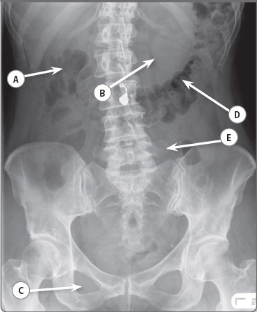 Plicae Circulares X Ray