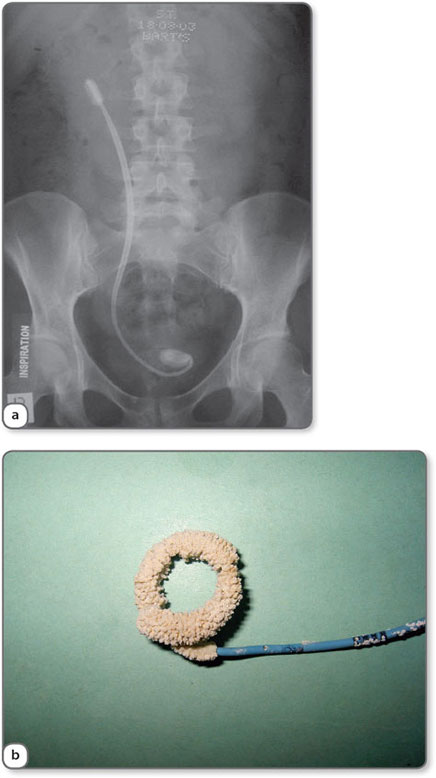 Double J Stent Removal