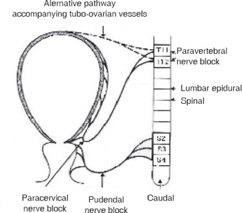 Paracervical Block During Labor