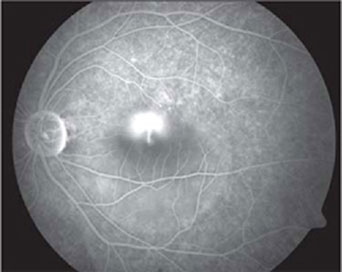 Central Serous Retinopathy Smokestack