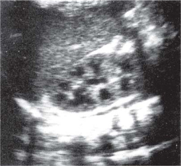 Neonatal Echogenic Renal Pyramids