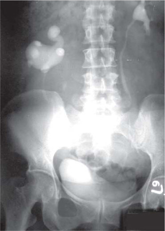 Chronic Pyelonephritis Ivp