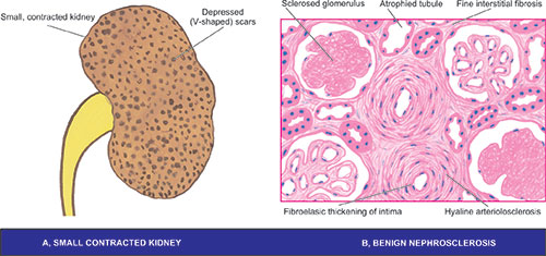 Hyaline Arteriolosclerosis Benign Nephrosclerosis