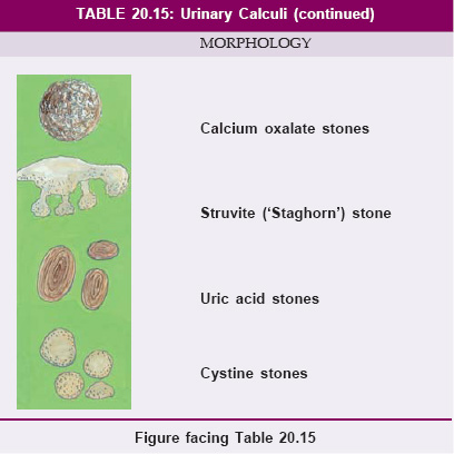 Urinary Calculi Ppt