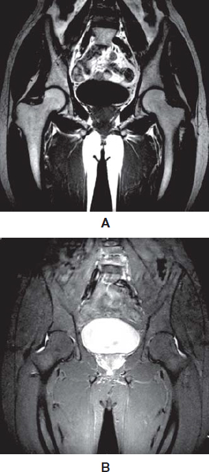 Fovea Centralis Femur Mri