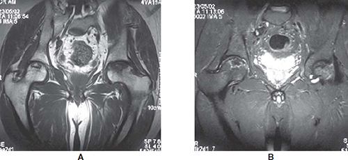 Fovea Centralis Femur Mri