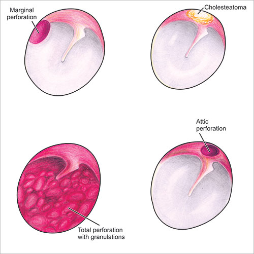 Chronic Suppurative Otitis Media Tubotympanic Type Chronic Suppurative