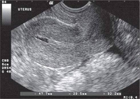 Myometrium Is Homogeneous