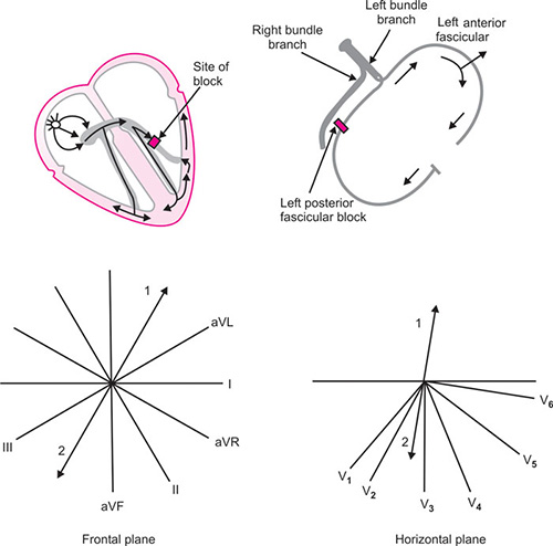 Left Anterior And Posterior Fascicle