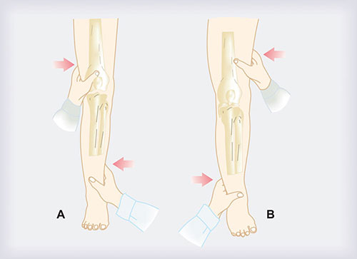 Valgus Stress Test JaypeeDigital | EBook Reader