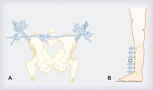 External Internal Fixation Dcp And Cast Syndrome