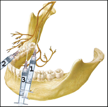 Coronoid Notch And Pterygomandibular Raphe