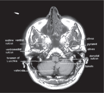 Foramina Of Luschka Radiology