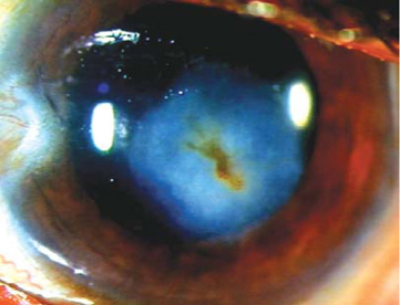 Hudson Stahli Line Cornea
