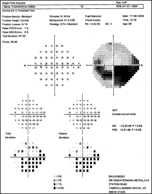 Which Is And Nasal Visual Field Interpretation