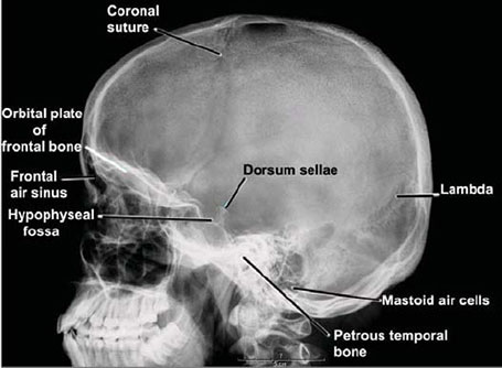 Dorsum Sellae Xray
