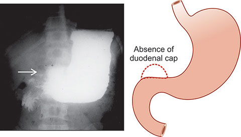 Duodenal Cap Image Clipart