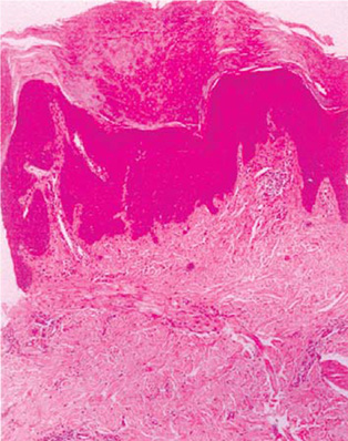 Lichen Simplex Chronicus Histology