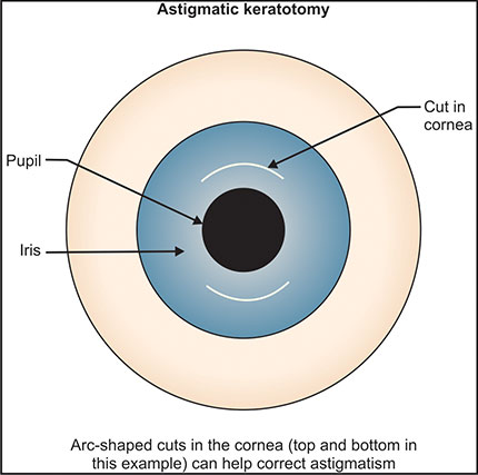 Astigmatic Keratotomy
