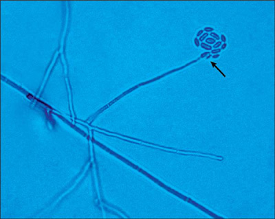 Acremonium Falciforme