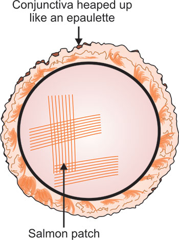 Interstitial Keratitis Salmon Patch