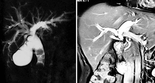Mrcp Findings Of Choledocholithiasis