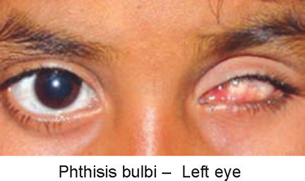 Phthisis Bulbi