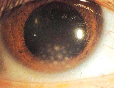 Mutton Fat Keratic Precipitates