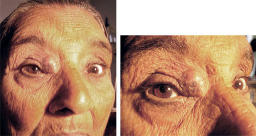 Truck Driver Sun Damage Arm