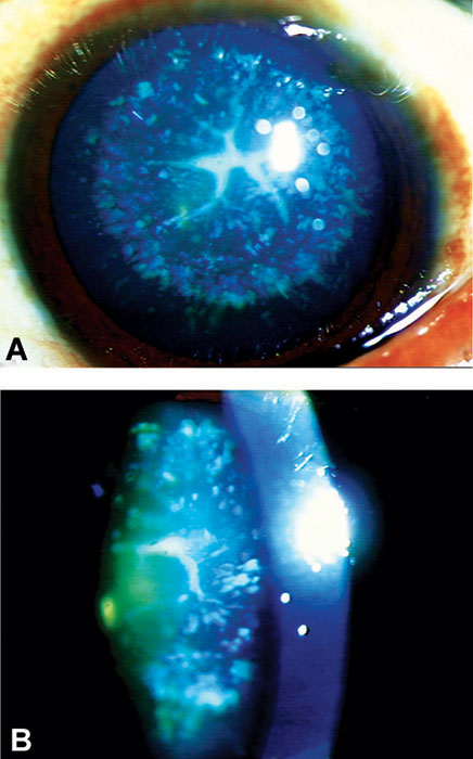 Blue Dot Cataract