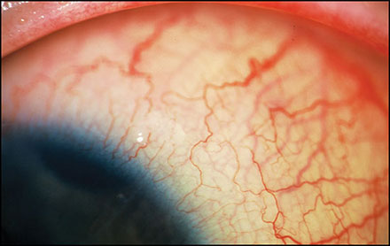 Bulbar Conjunctival Hyperemia