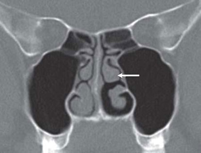 Antrectomy Sinus Radiology