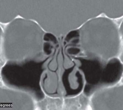 Antrectomy Sinus Radiology