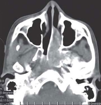 Antrectomy Sinus Radiology