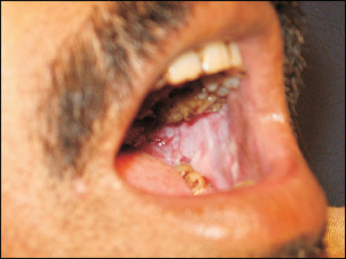 Morsicatio Buccarum Temporalis