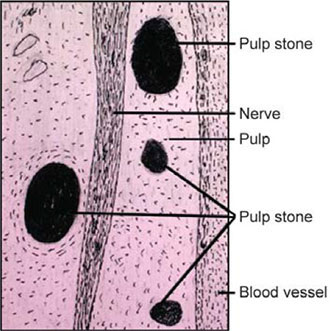 Pulp Stones Diagram