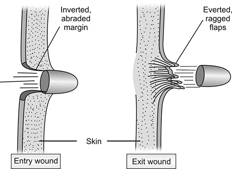 Difference Between Entry And Exit Gunshot Wounds