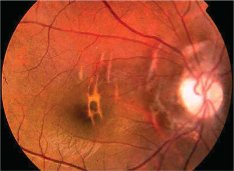 Choroidal Crescent Optic Nerve