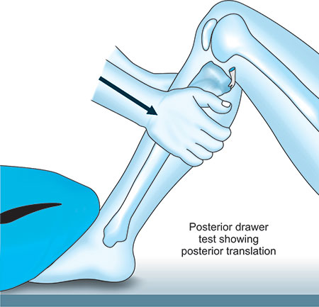 Posterior Drawer Test Grading