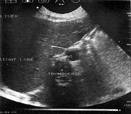 Transverse Liver Ultrasound Diaphragm