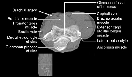 Elbow Anatomy Ct