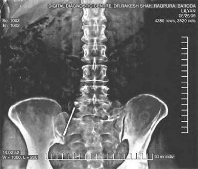 Sacralization Xray
