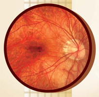 Choroidal Crescent