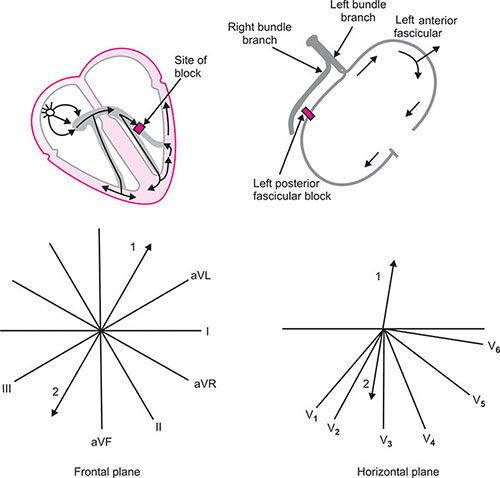 Left Anterior Fascicle