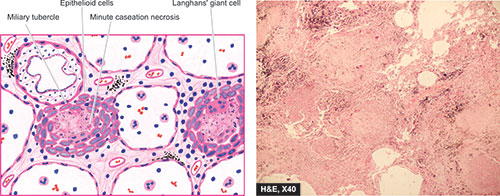 Tubercle Lung