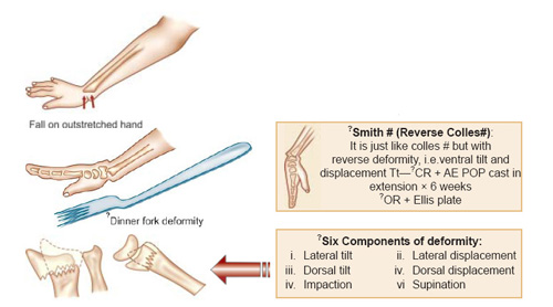 Colles Fracture Dinner Fork