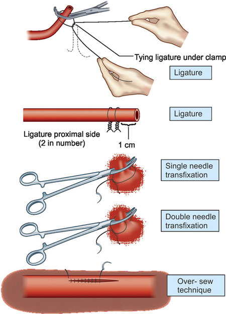 What Is Artery Ligation